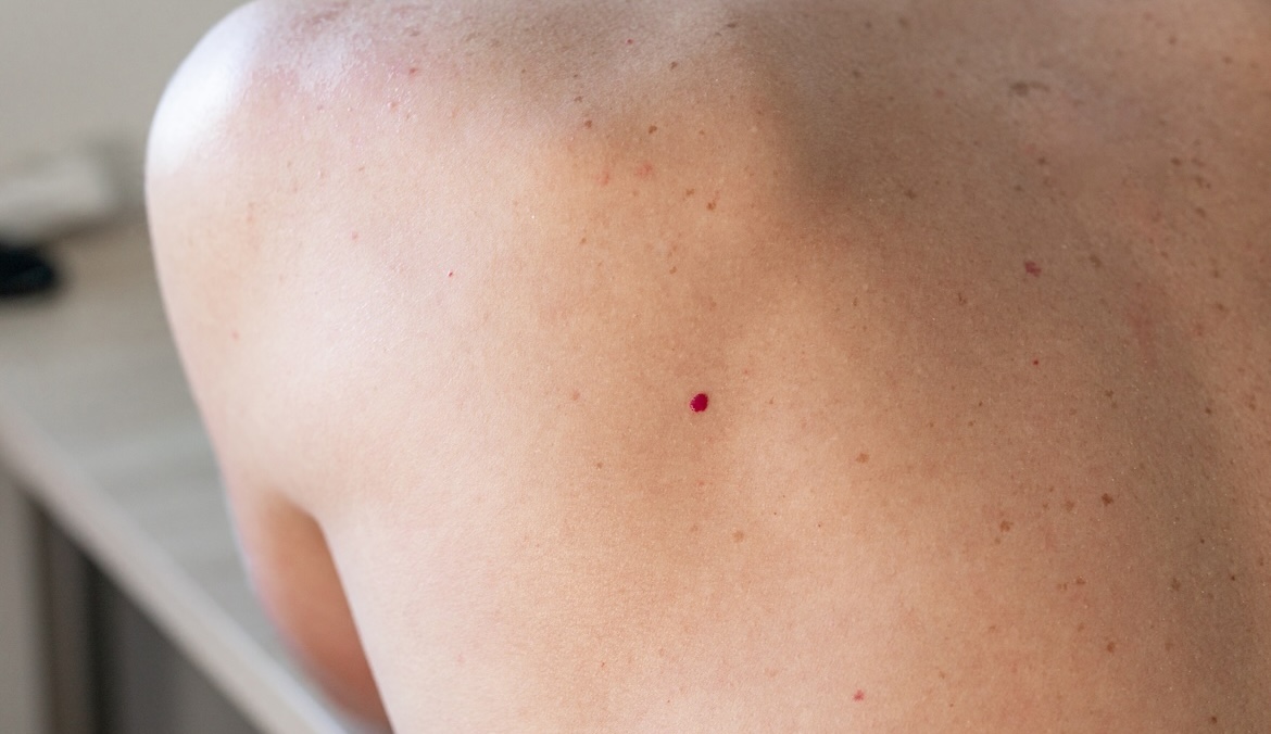 Red Moles on Skin: Causes, Removal, and When to See a Doctor – P-HealthX