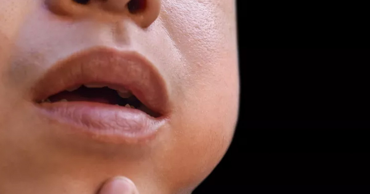 Parotitis: Signs, Symptoms, and Treatment : The Hearty Soul – P-HealthX